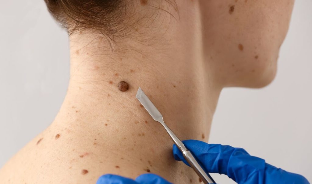 Skin Cancer Checks: ABCD Rule for Early Detection | Buderim Medical Centre